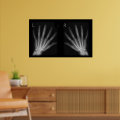 Extra Digit X-ray Right & Left Hands Poster | Zazzle