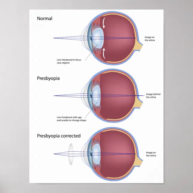 Eye defect presbyopia Poster | Zazzle