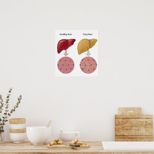 Fatty liver disease Poster | Zazzle