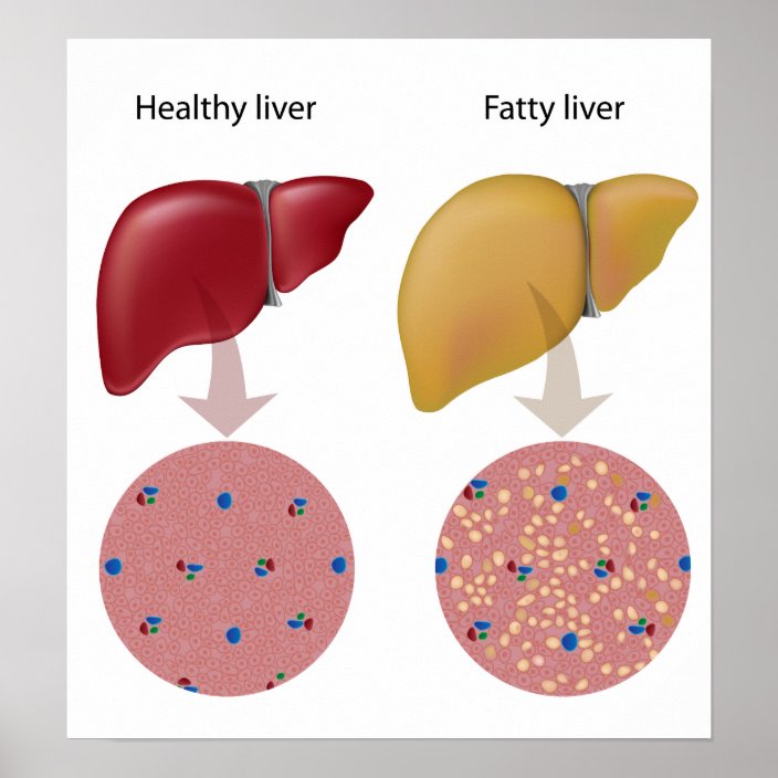 Fatty liver disease Poster | Zazzle.com