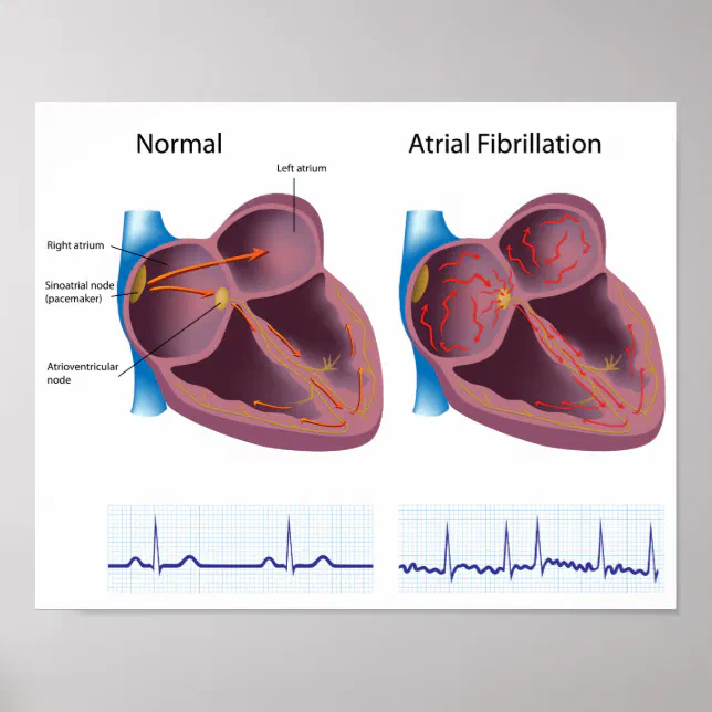 Heart disease atrial fibrillation Poster | Zazzle