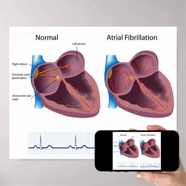 Heart disease atrial fibrillation Poster | Zazzle