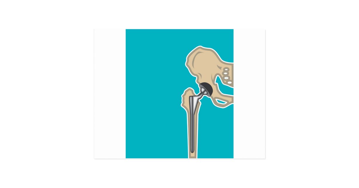 Hip Joint Replacement Postcard | Zazzle.com