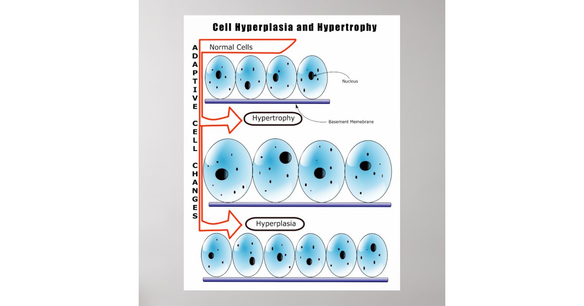 Hyperplasia and Hypertrophy Comparison Chart Poster | Zazzle