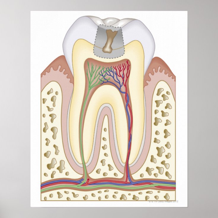 Illustration of Tooth Decay Poster | Zazzle