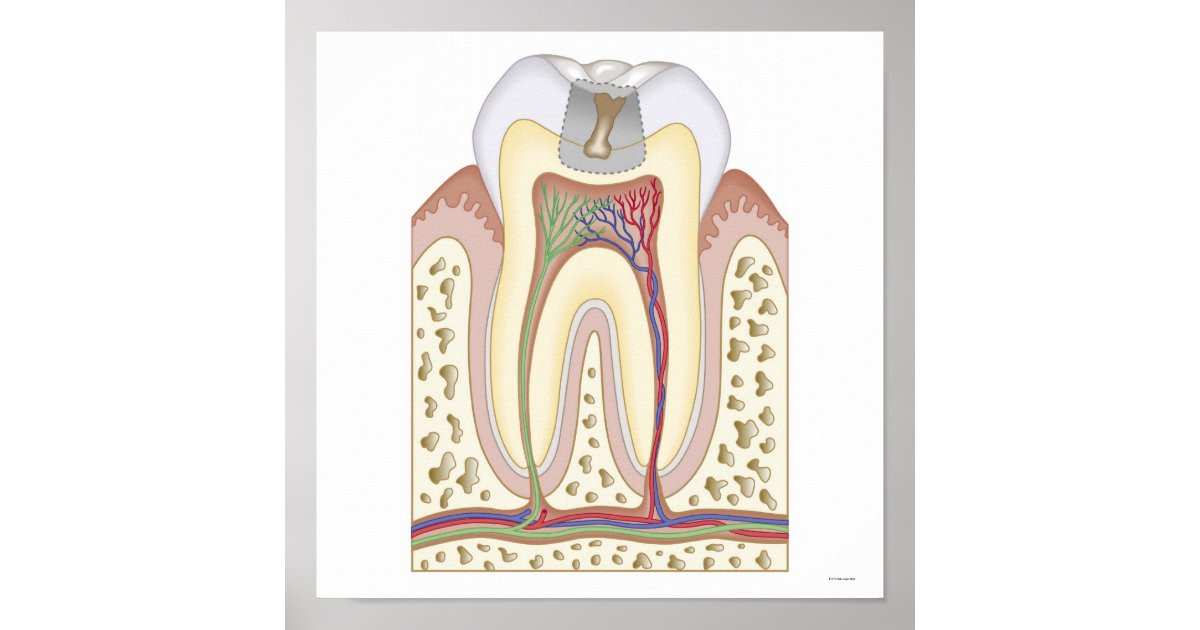 Illustration of Tooth Decay Poster | Zazzle