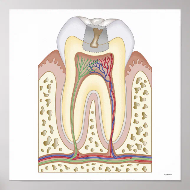 Illustration of Tooth Decay Poster | Zazzle