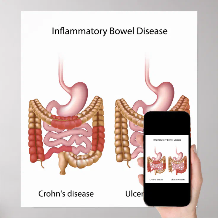 inflammatory bowel disease (ibd) poster | Zazzle
