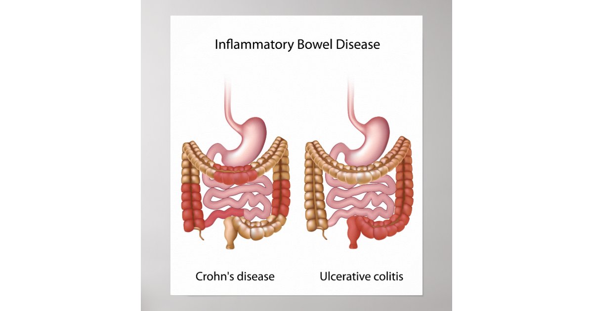 inflammatory bowel disease (ibd) poster | Zazzle
