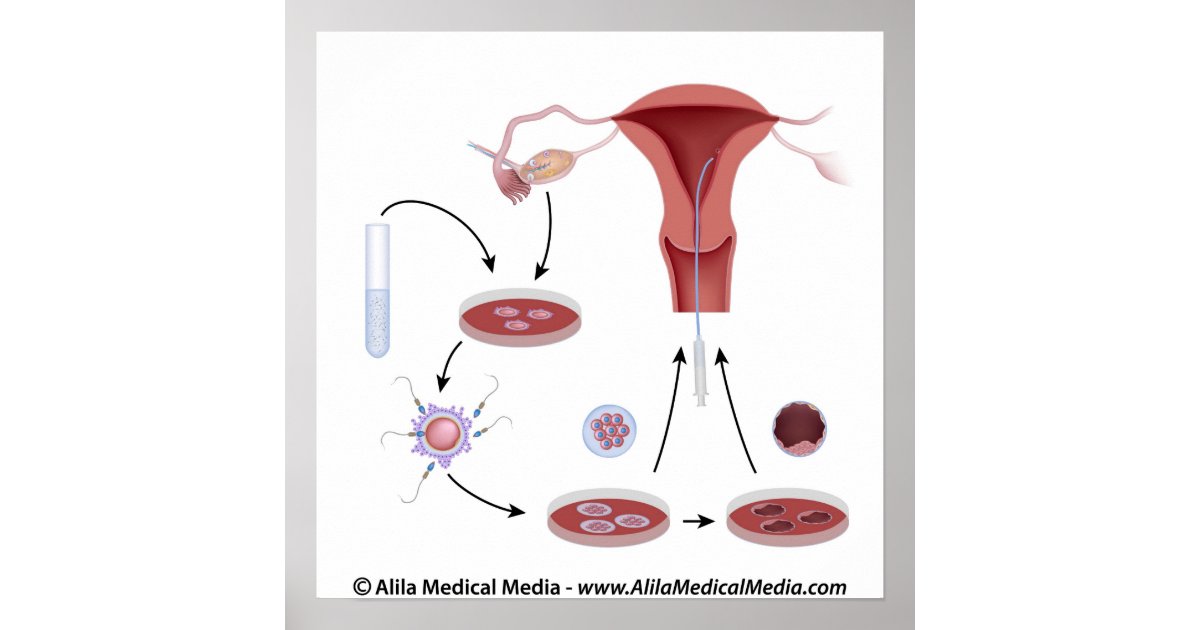 IVF procedure unlabeled diagram. Poster | Zazzle