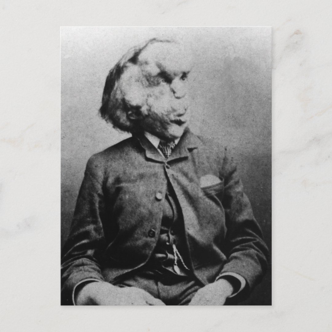 Joseph "John" Merrick The Elephant Man from 1889 Postcard | Zazzle