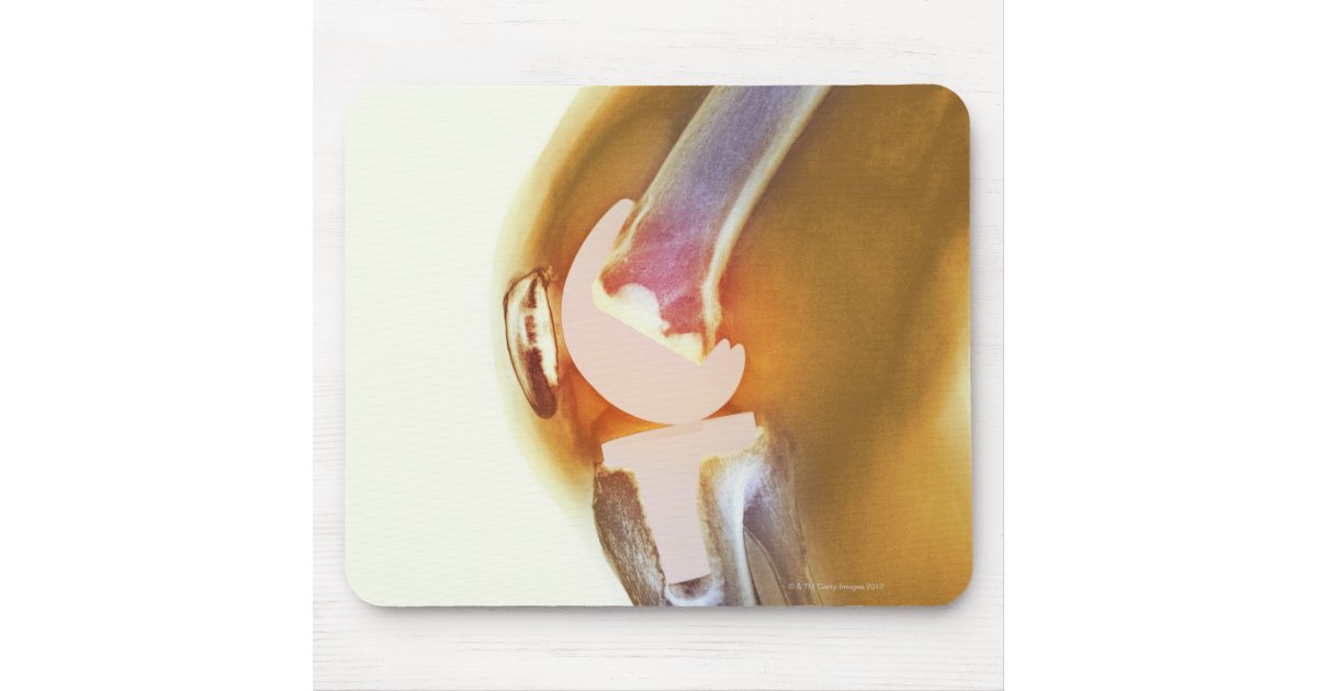 Knee replacement. Coloured X-ray of a total knee Mouse Pad | Zazzle