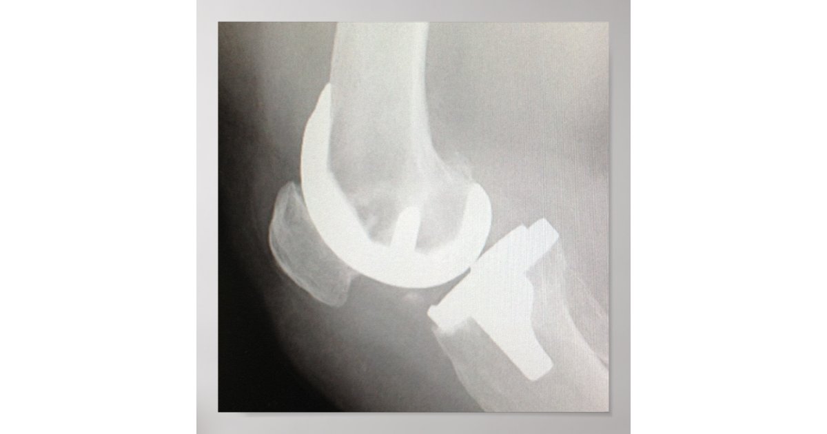 Knee Replacement - poster | Zazzle