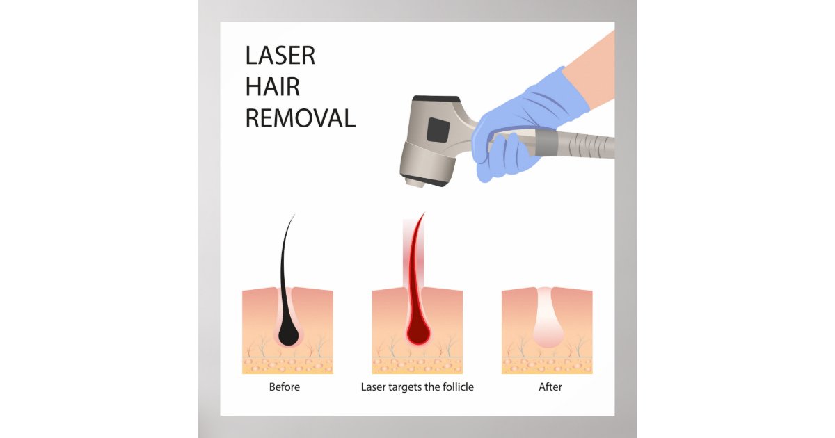 Laser hair removal poster | Zazzle