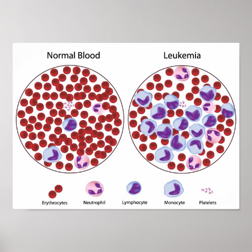Leukemia Poster | Zazzle