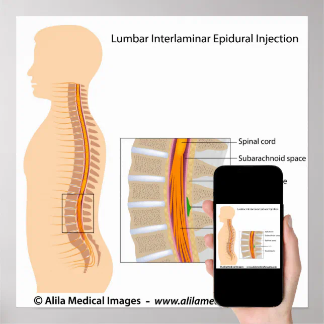 Lumbar epidural injection, labeled diagram. poster | Zazzle