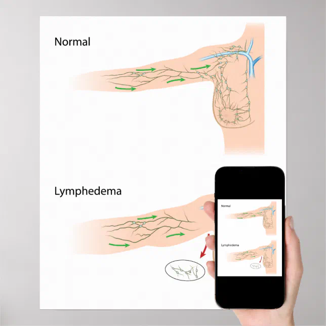 lymphedema arm disease diagram poster | Zazzle
