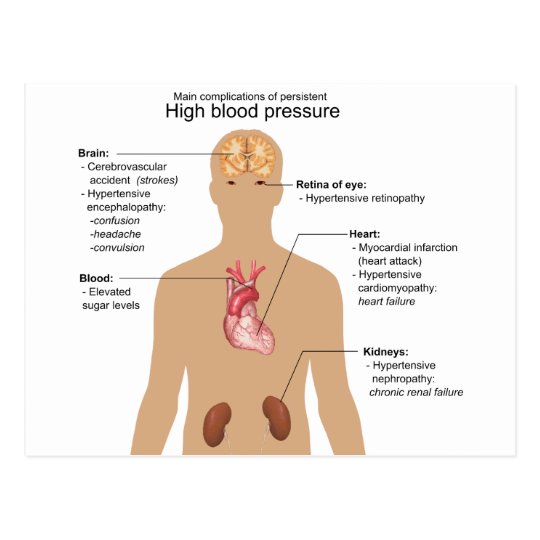 Main Complications of High Blood Pressure Chart Postcard | Zazzle.com