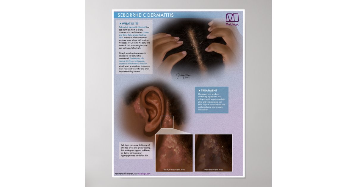 Melalogic Seborrheic Dermatitis (Dandruff) Medical Poster | Zazzle