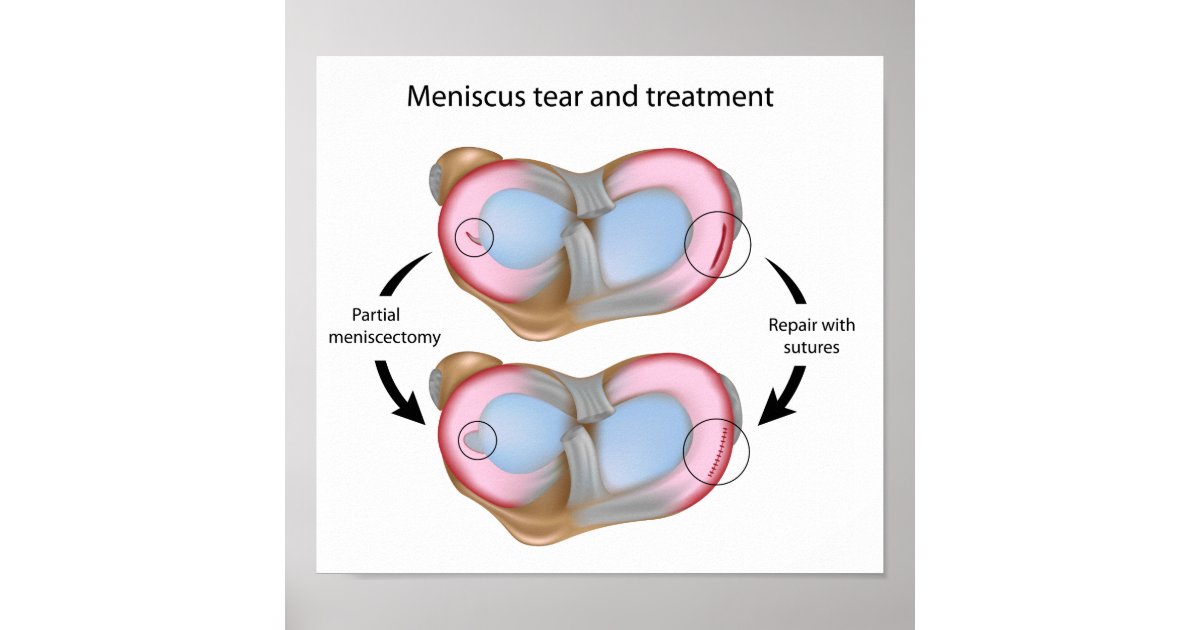 Meniscus tear and surgery Poster | Zazzle