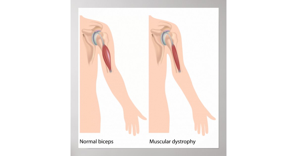 Muscular dystrophy Poster | Zazzle