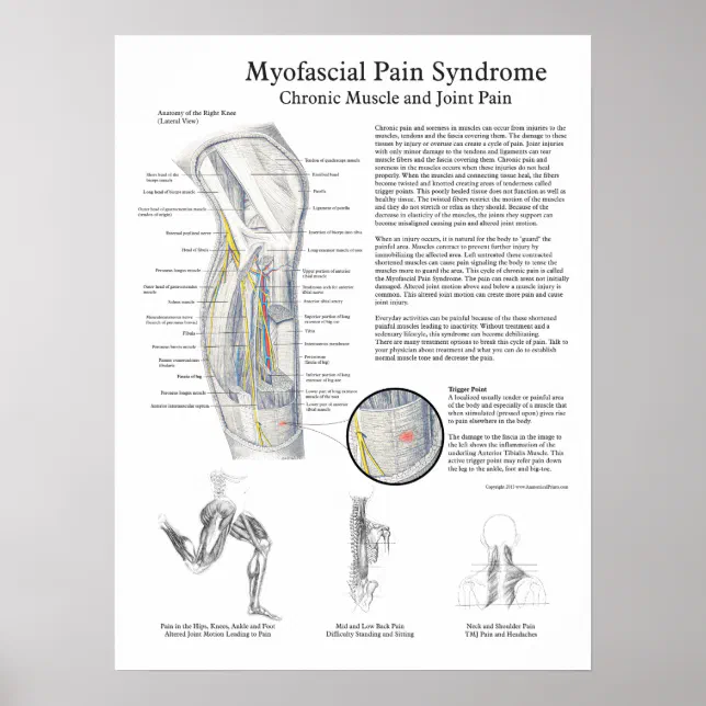 Myofascial Pain Syndrome Poster | Zazzle