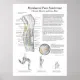 Myofascial Pain Syndrome Poster | Zazzle