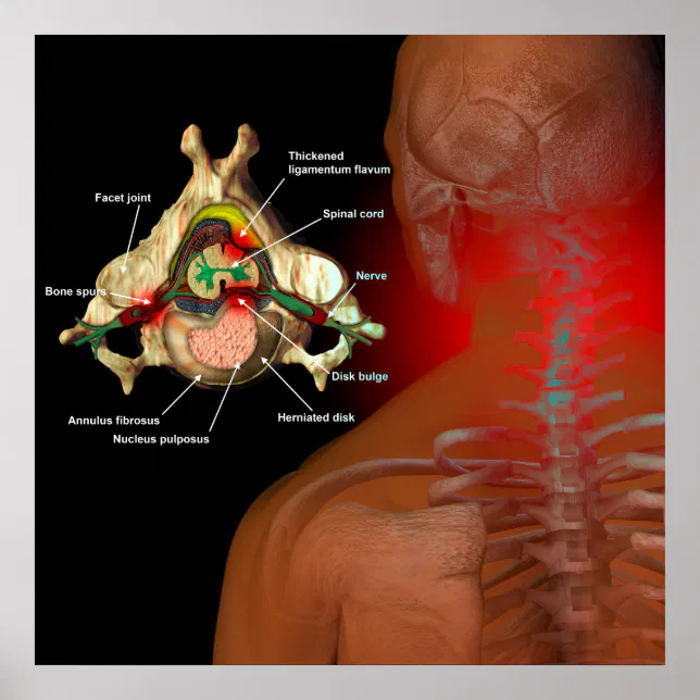 Neck pain poster | Zazzle