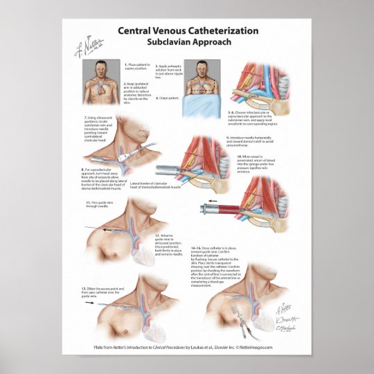 Netter Chart: Central Venous Catheterization Poster | Zazzle.com