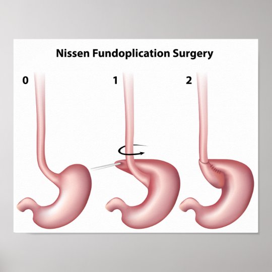 Nissen Fundoplication stomach Surgery Poster | Zazzle.com