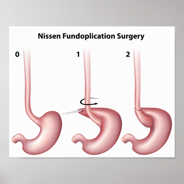 Nissen Fundoplication stomach Surgery Poster | Zazzle.com