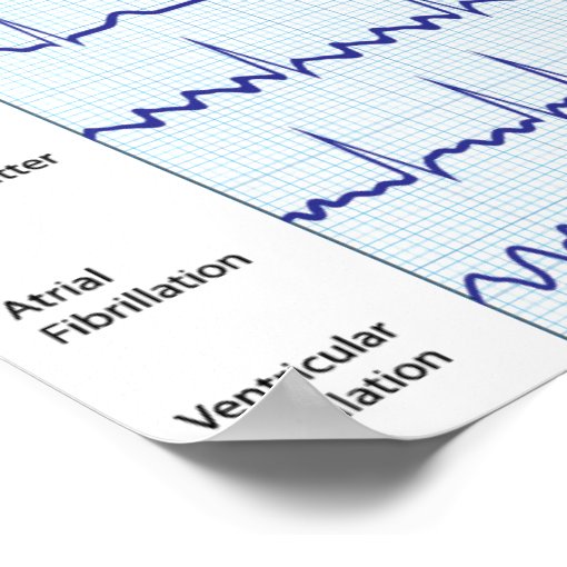 Normal and pathological ecg Poster | Zazzle