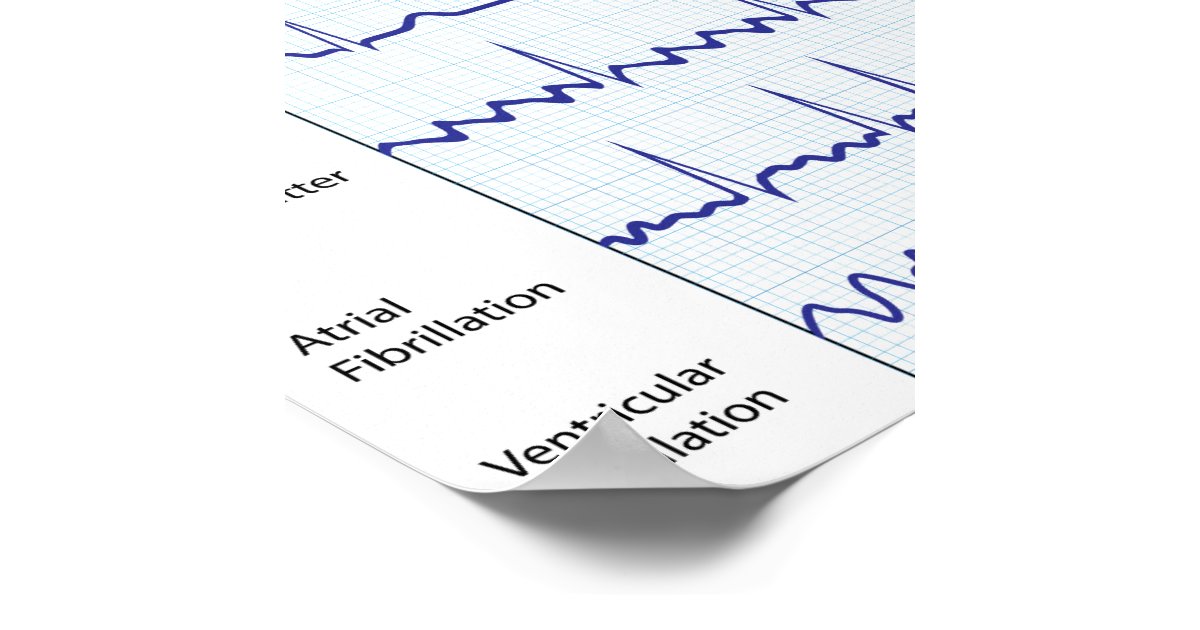 Normal and pathological ecg Poster | Zazzle.com