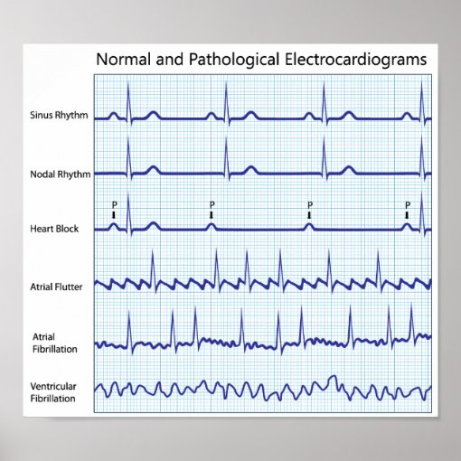 Normal and pathological ecg Poster | Zazzle
