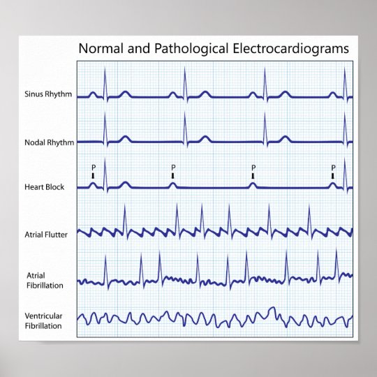 Normal and pathological ecg Poster | Zazzle.com