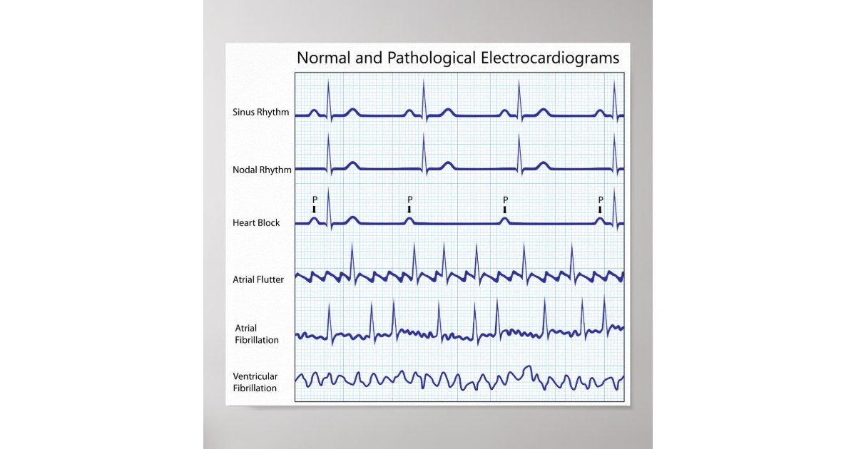 Normal and pathological ecg Poster | Zazzle