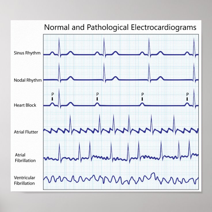 Normal and pathological ecg Poster | Zazzle
