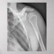 Normal shoulder. X-ray of the healthy left Poster | Zazzle