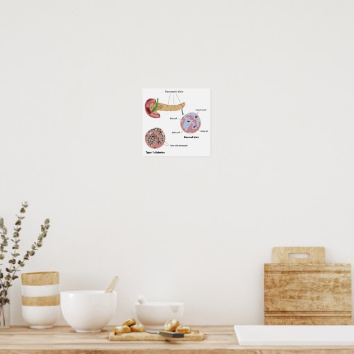 Pancreatic islet and diabetes Poster | Zazzle
