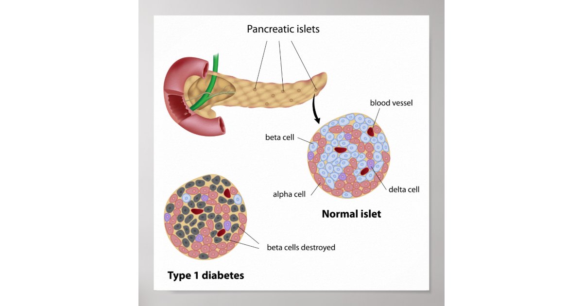 Pancreatic islet and diabetes Poster | Zazzle
