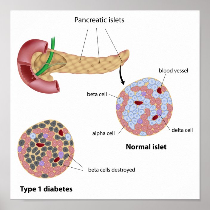 Pancreatic islet and diabetes Poster | Zazzle