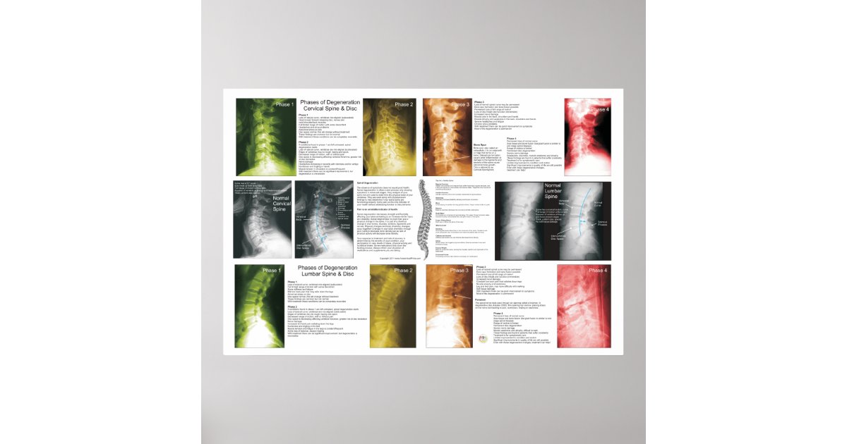 Phases Cervical Lumbar Spinal Degeneration Poster | Zazzle
