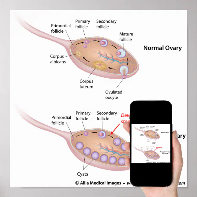 Polycystic ovary syndrome, labeled diagram. poster | Zazzle