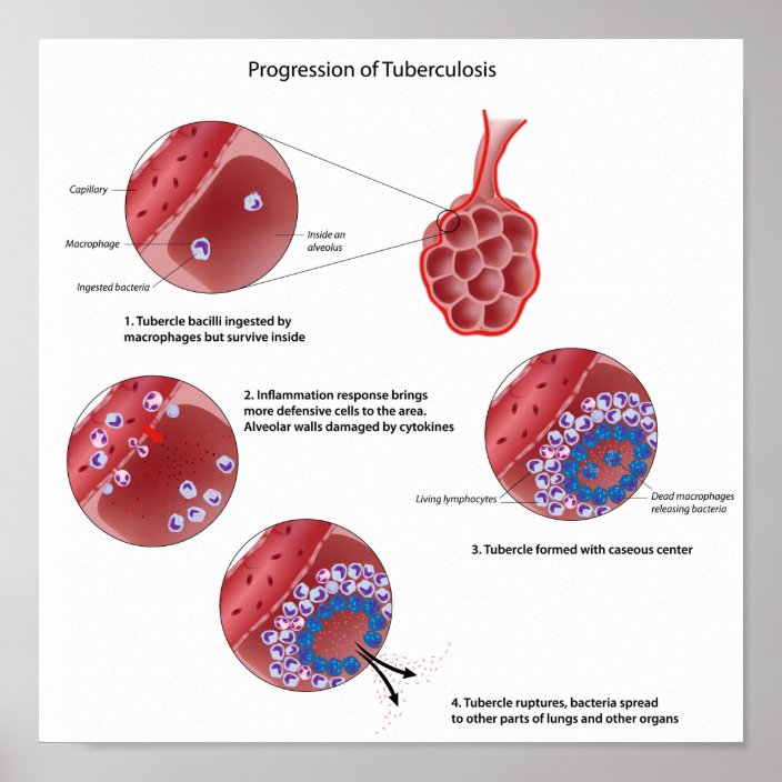 Progression of pulmonary tuberculosis Poster | Zazzle.com