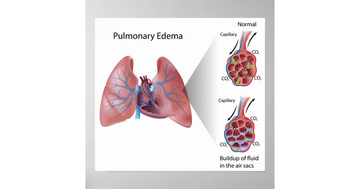 Pulmonary edema Poster | Zazzle