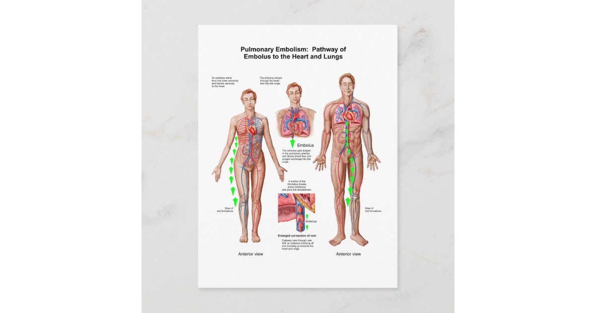 Pulmonary Embolism, Pathway Of Embolus Postcard | Zazzle