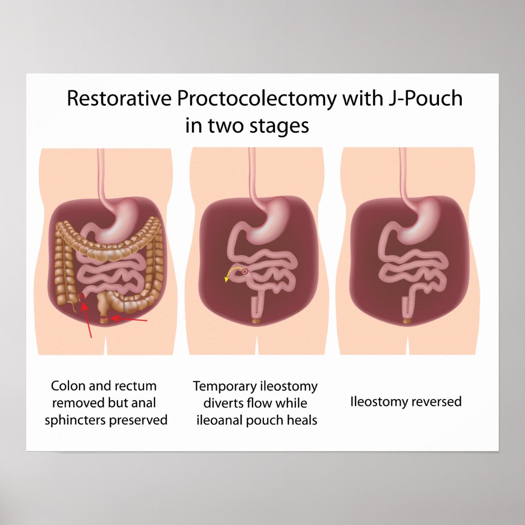 Restorative proctocolectomy with j-pouch 2 stages poster | Zazzle