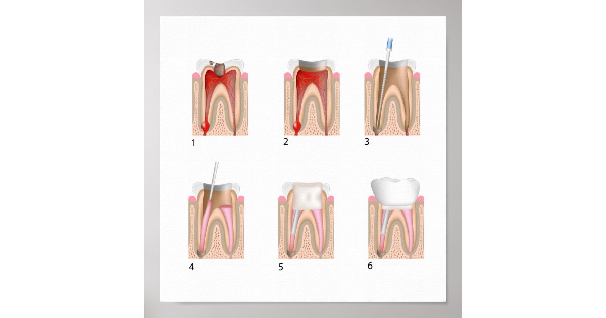 Root canal treatment Any size Poster | Zazzle