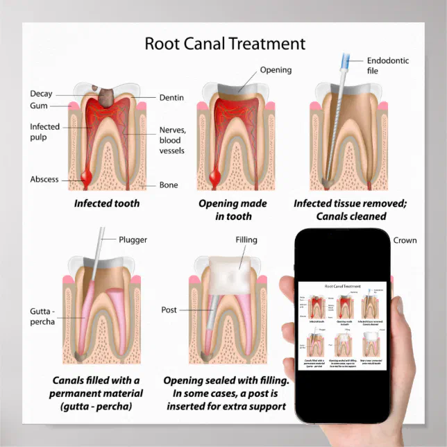 Root canal treatment Poster | Zazzle