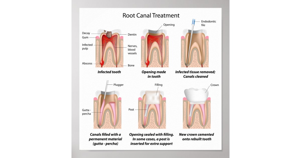 Root canal treatment Poster | Zazzle